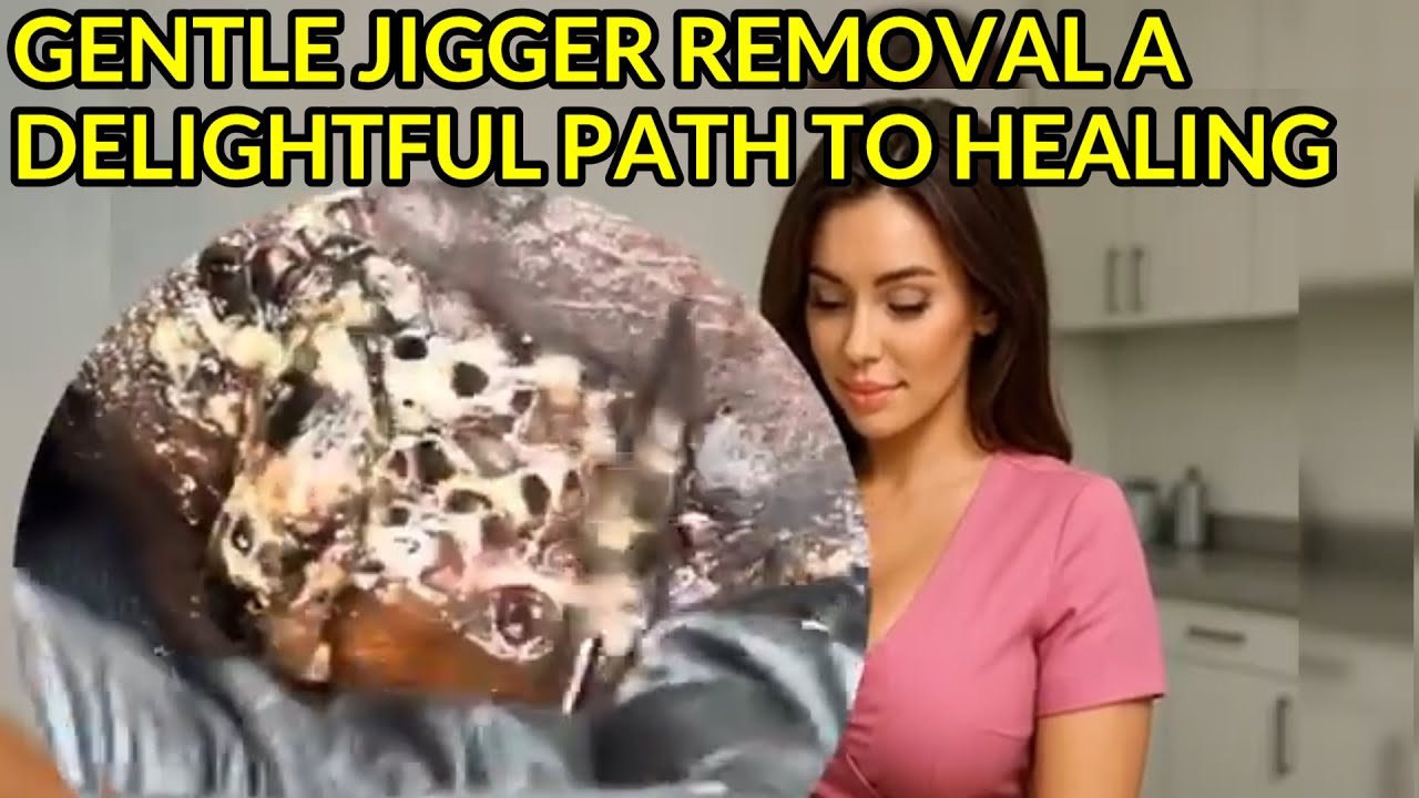 Gentle Jigger Removal | A Delightful Path to Healing - YouTube