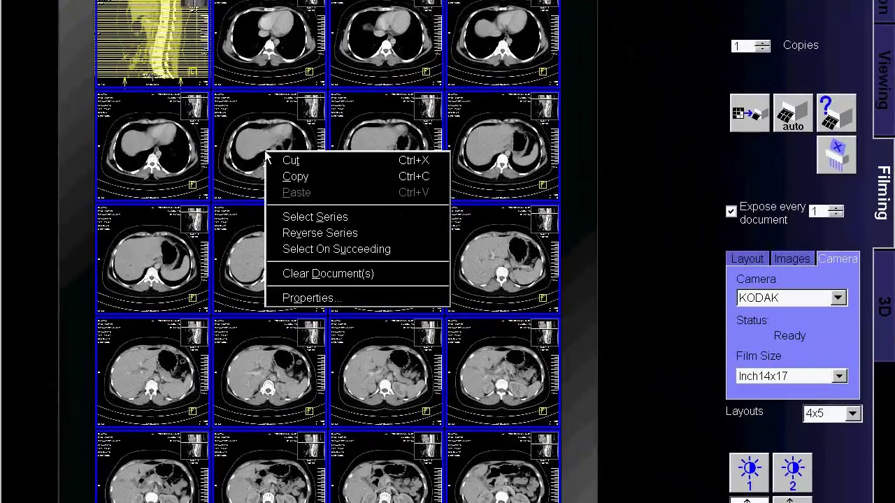 CT scan of HBS Pancreas Filming (SIEMENS) - YouTube