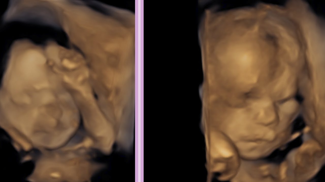 Roseane & Lees little one at 24 weeks! 4D baby bonding ultrasound scan ...
