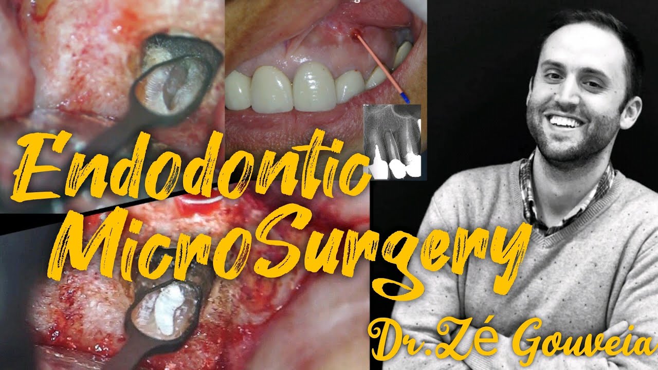 Endodontic Microsurgery . Root canal treatment . Dr. Zé Gouveia - YouTube