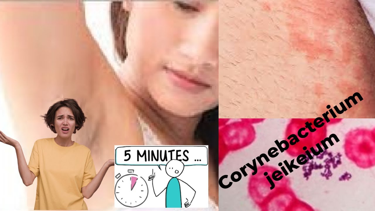 corynebacterium microbiology lecture ||Corynebacterium jeikeium ||Easy Microbiology - YouTube