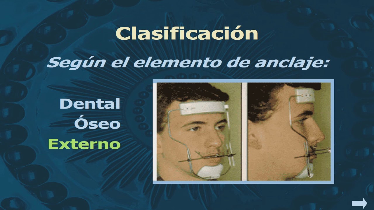 Control de Anclaje durante el tratamiento ortodóntico - YouTube