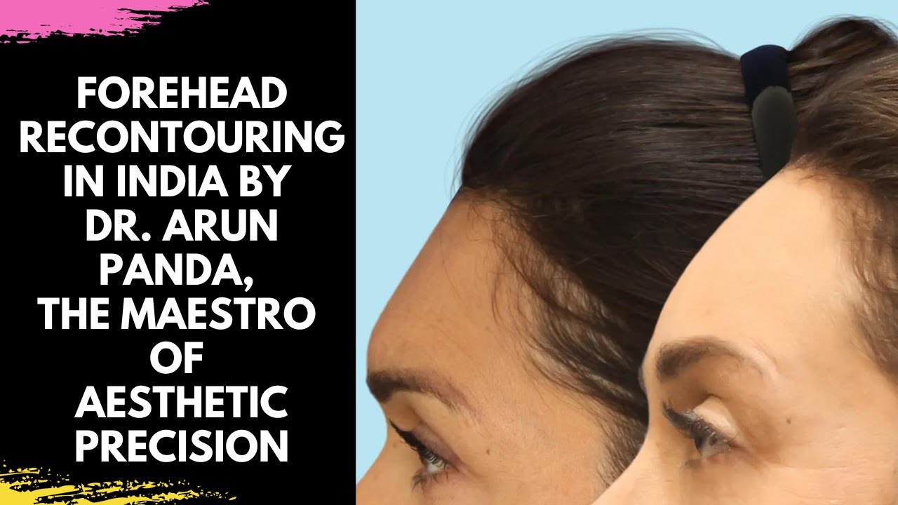 Forehead Recontouring in India by Dr. Arun Panda, the Maestro of ...