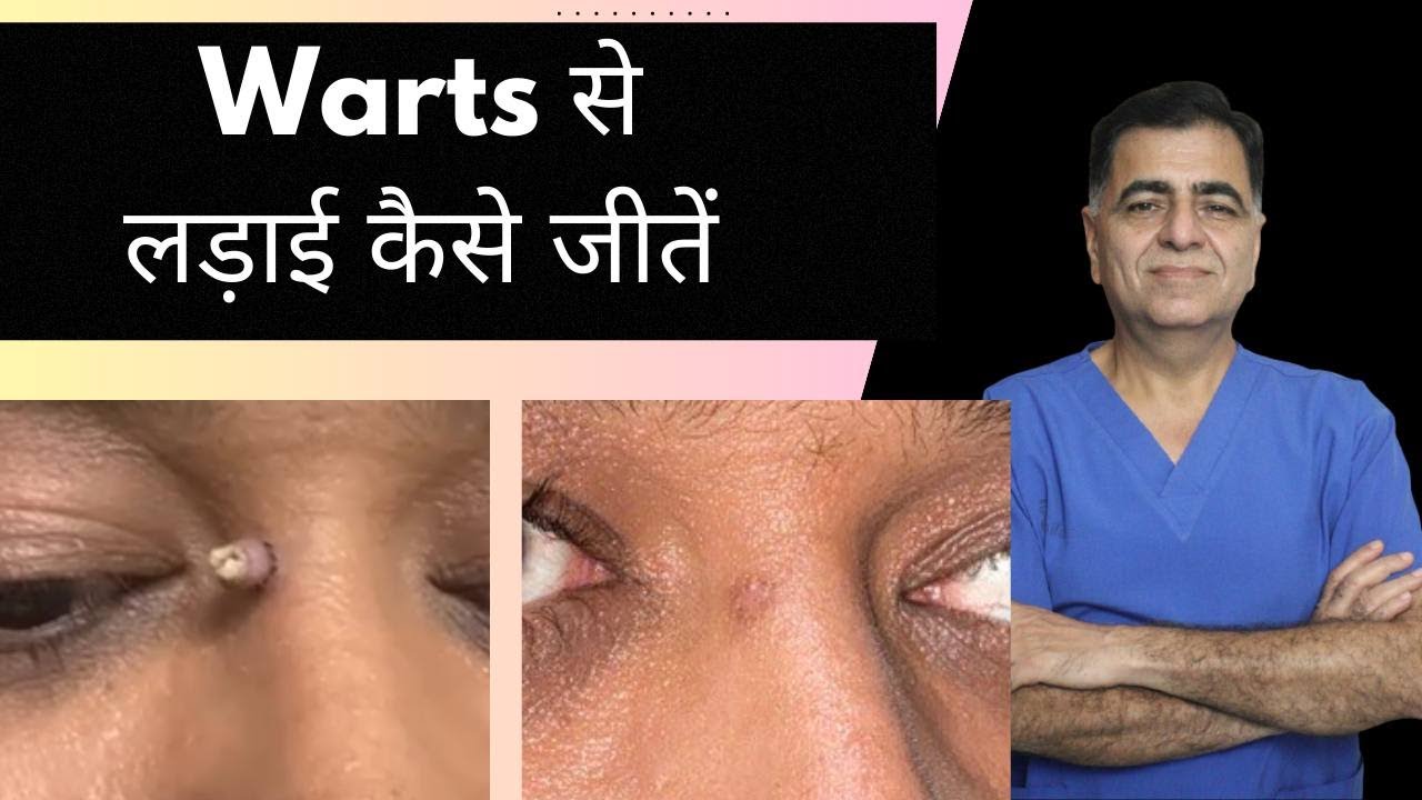 Painless, easy wart removal surgery || Dr. S. K. Gulati - YouTube