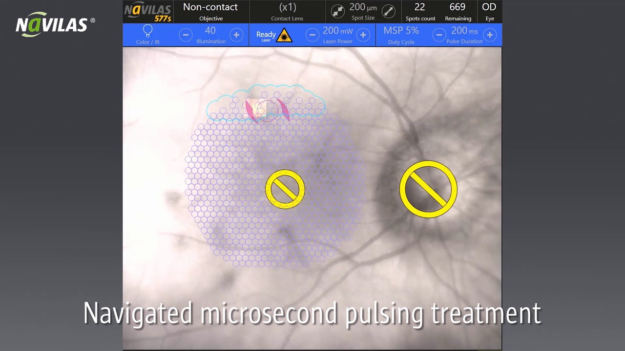 Navigated Microsecond Pulsing Treatment with the Navilas Retina Laser ...