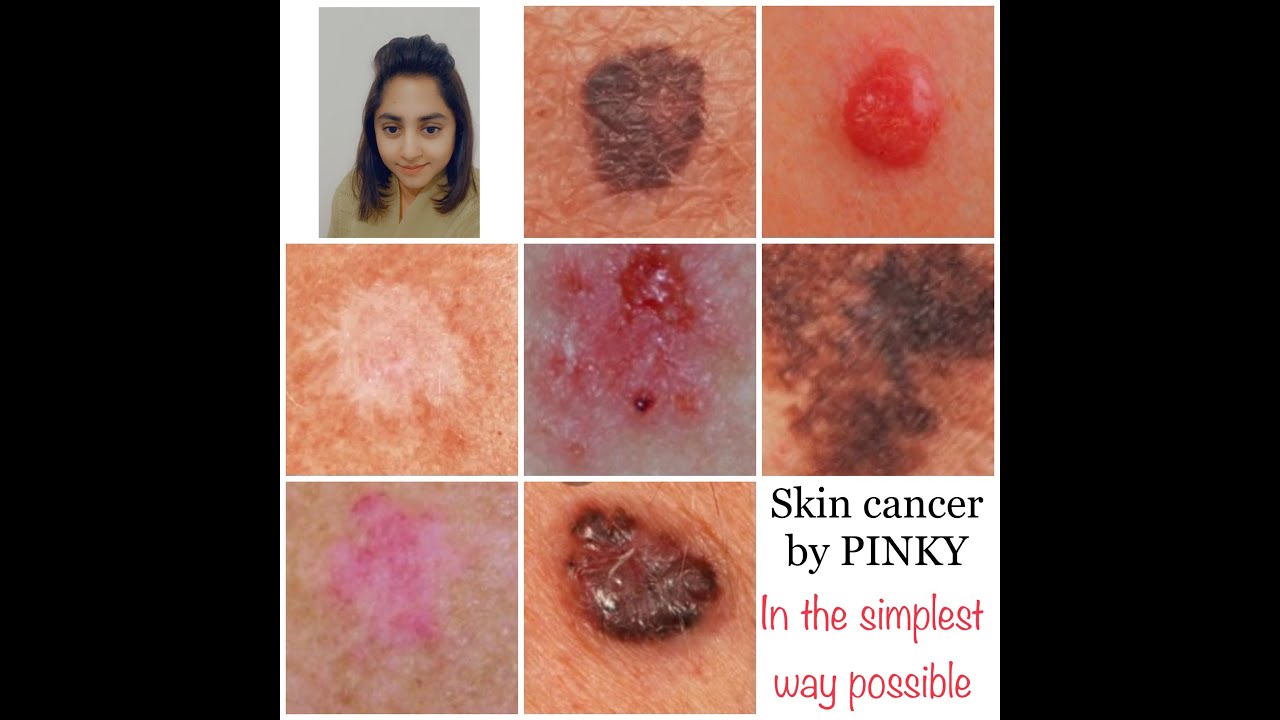 Skin cancer | Signs | 7 point checklist| Explained in the simplest way ...