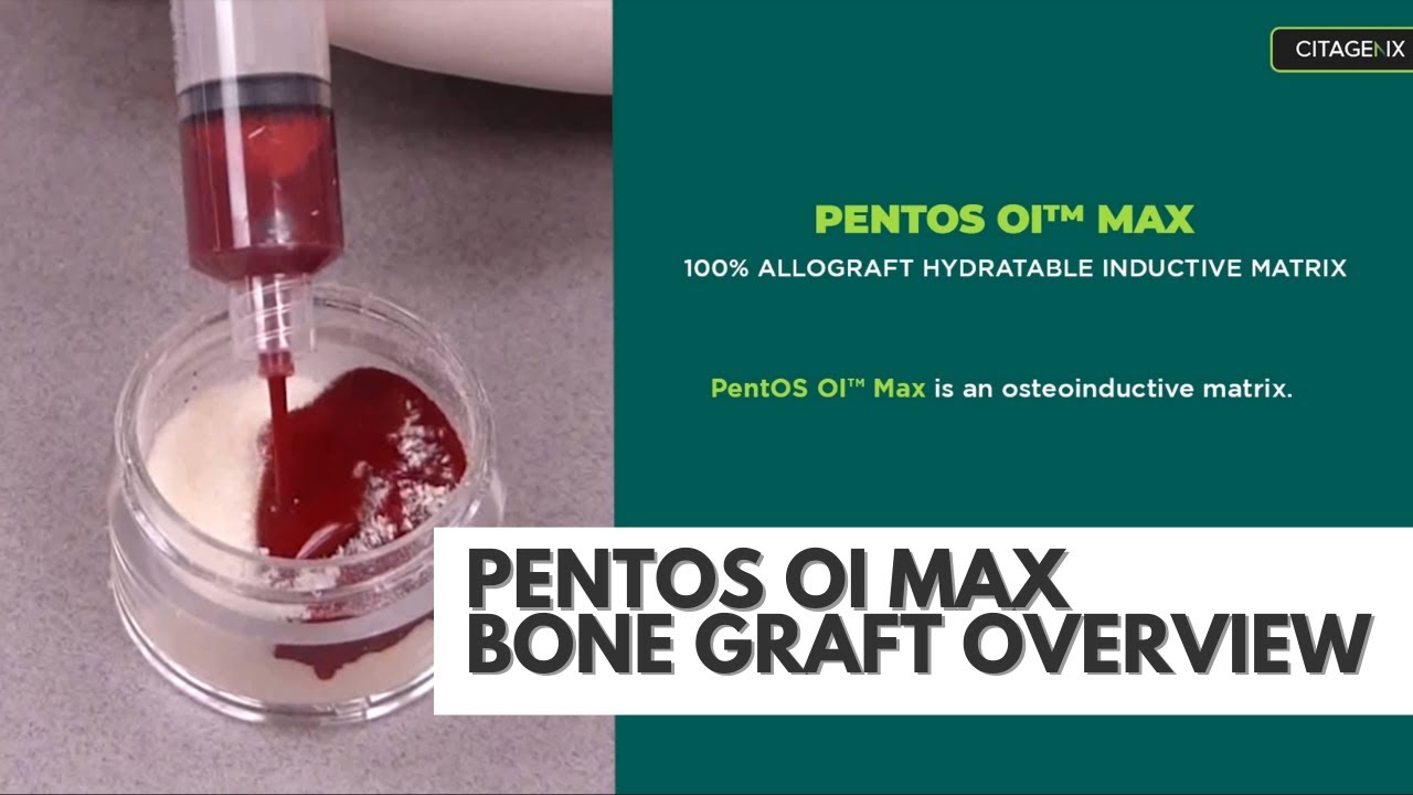 Bone Graft 100% Allograft Hydratable Inductive Matrix [PentOS OI Max ...