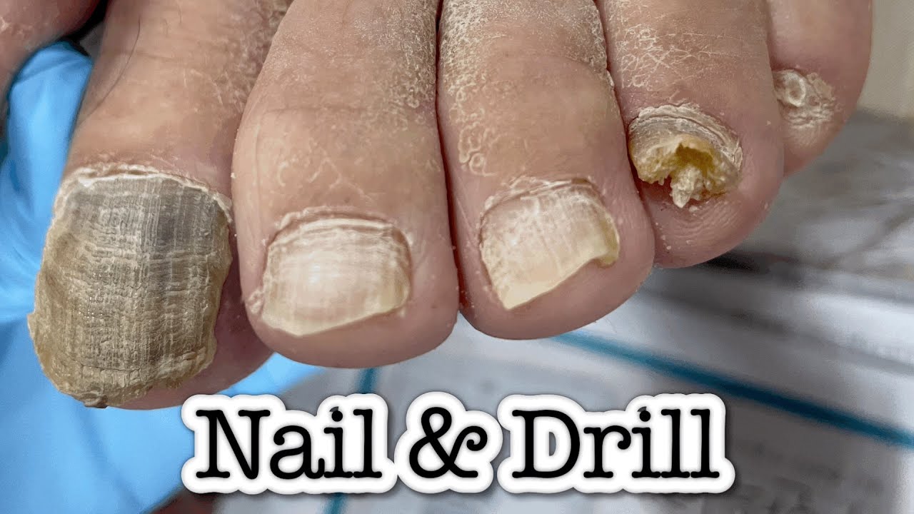 nail /toenail /nailcare /athlete’s foot /practice /nail&drill - YouTube