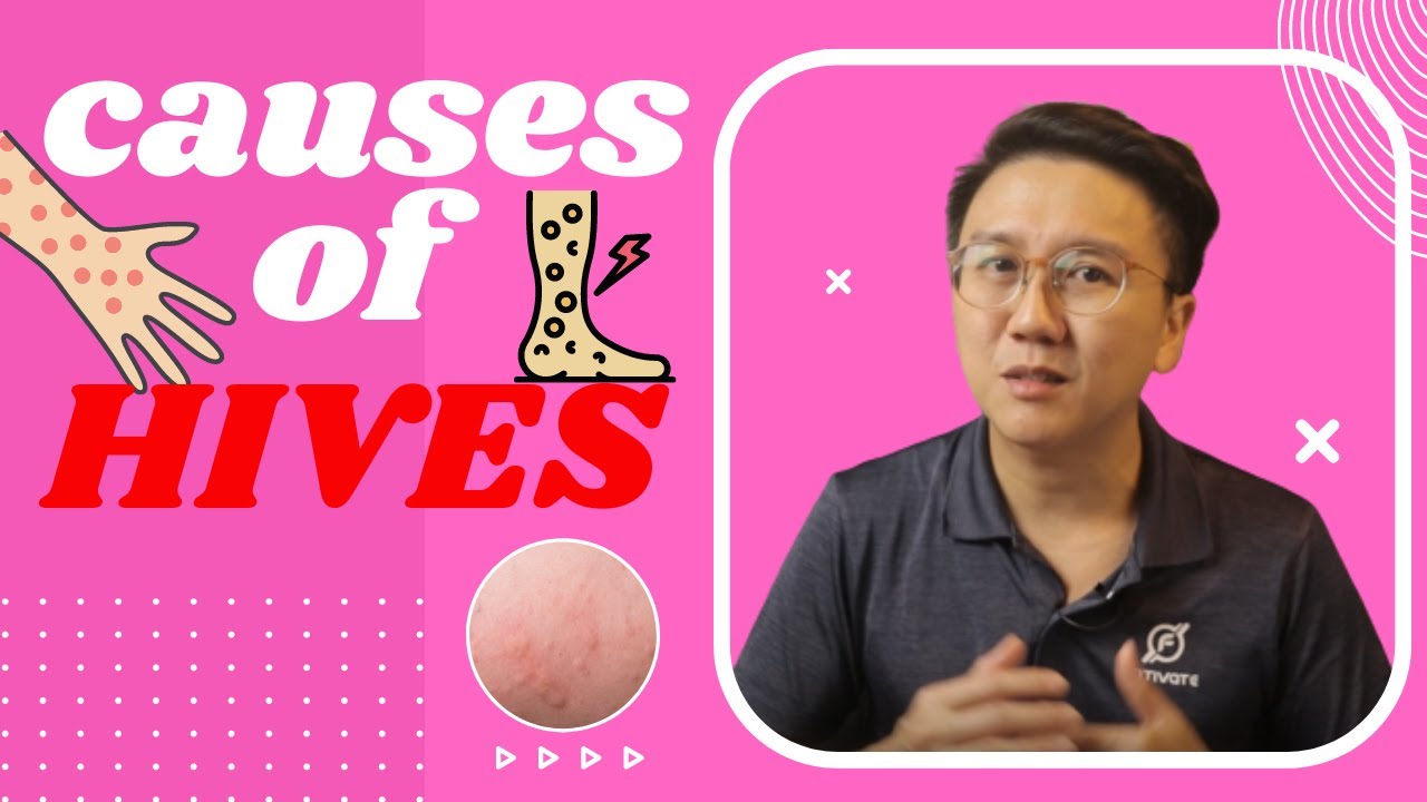 What are the causes of HIVES ? - YouTube