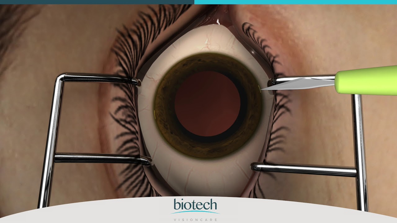 Eyecryl PHAKIC IOL Range Loading & Implantation - YouTube