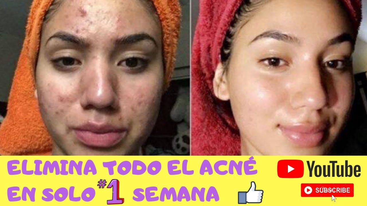 Como eliminar el Acné en solo 3 días muy efectivo - YouTube