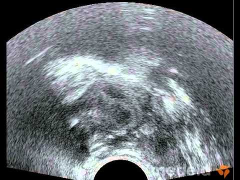 Ultrasound of an infant suck cycle - slow motion