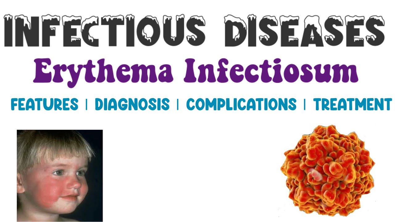 Erythema Infectiosum | Viral Infections | Infectious Diseases 3 ...