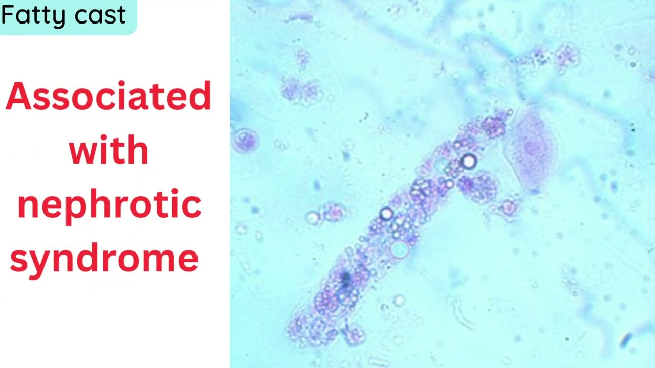 Kidney Casts In Urine Kidney Failure Disease RACGP Advances In