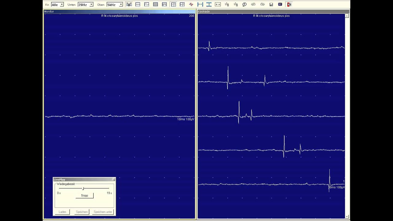 LEMG with insertion activity and interferring fibrillation potentials ...