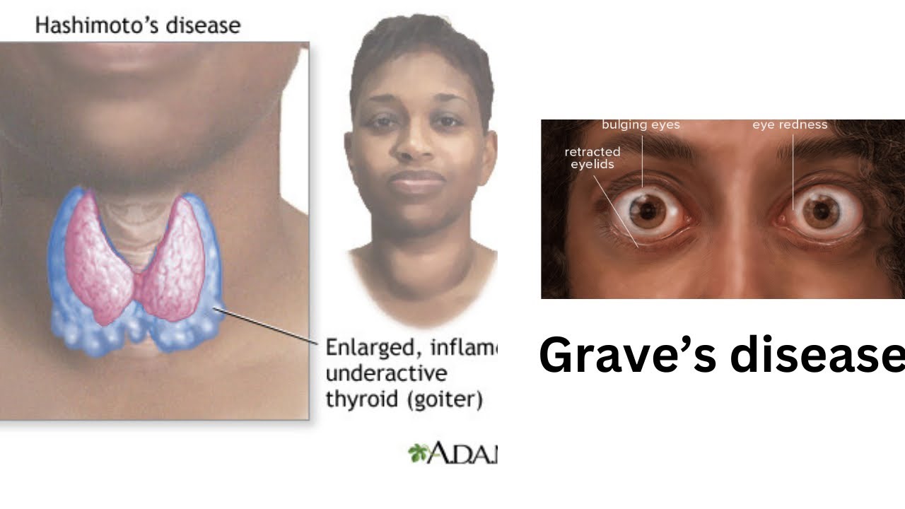 Hashimoto v/s grave’s disease @UnacademyLiveNEETPG @PrepLaddermedpg ...