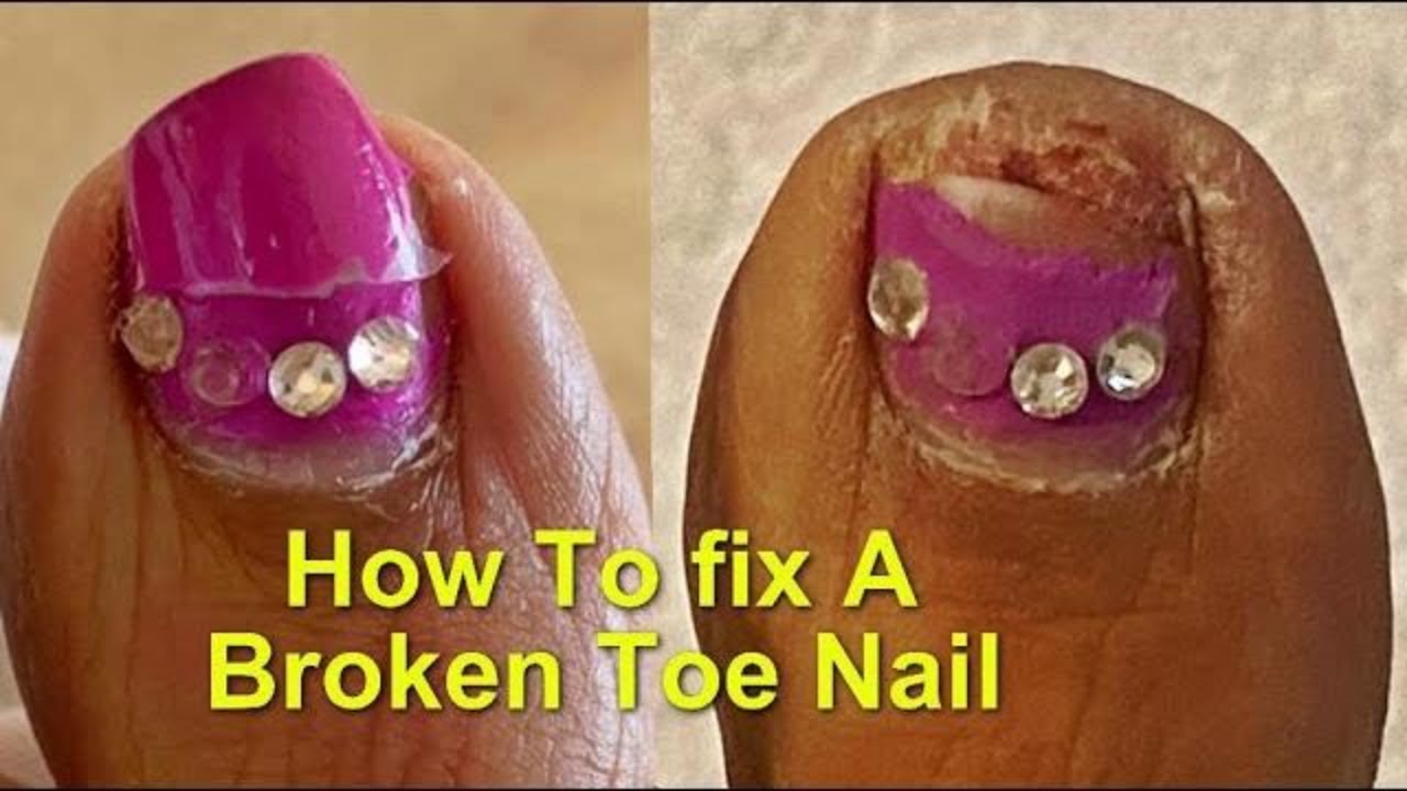 BROKEN TOENAIL/ASMR BROKEN TOENAIL TRANSFORMATION AT HOME EXTENSION ...