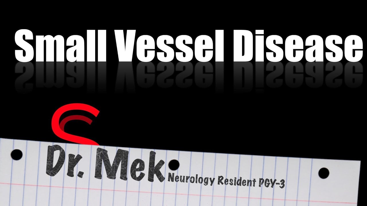 Strike Stroke with Dr. Mekdes: Lacunar stroke / small vessle disease ...