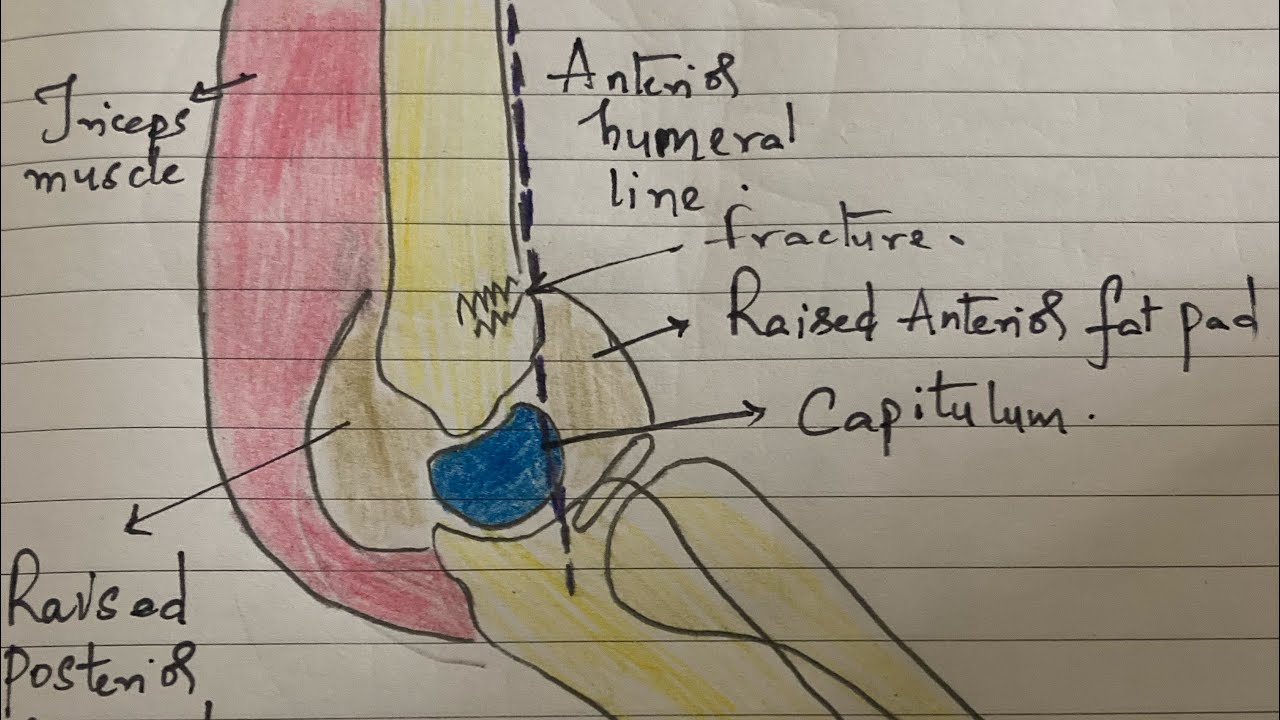 # Supracondylar fracture - anterior humeral line - YouTube