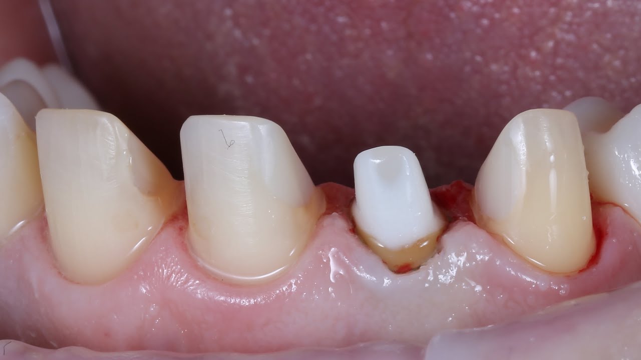 Crown preparation 13,12,11,21 - YouTube