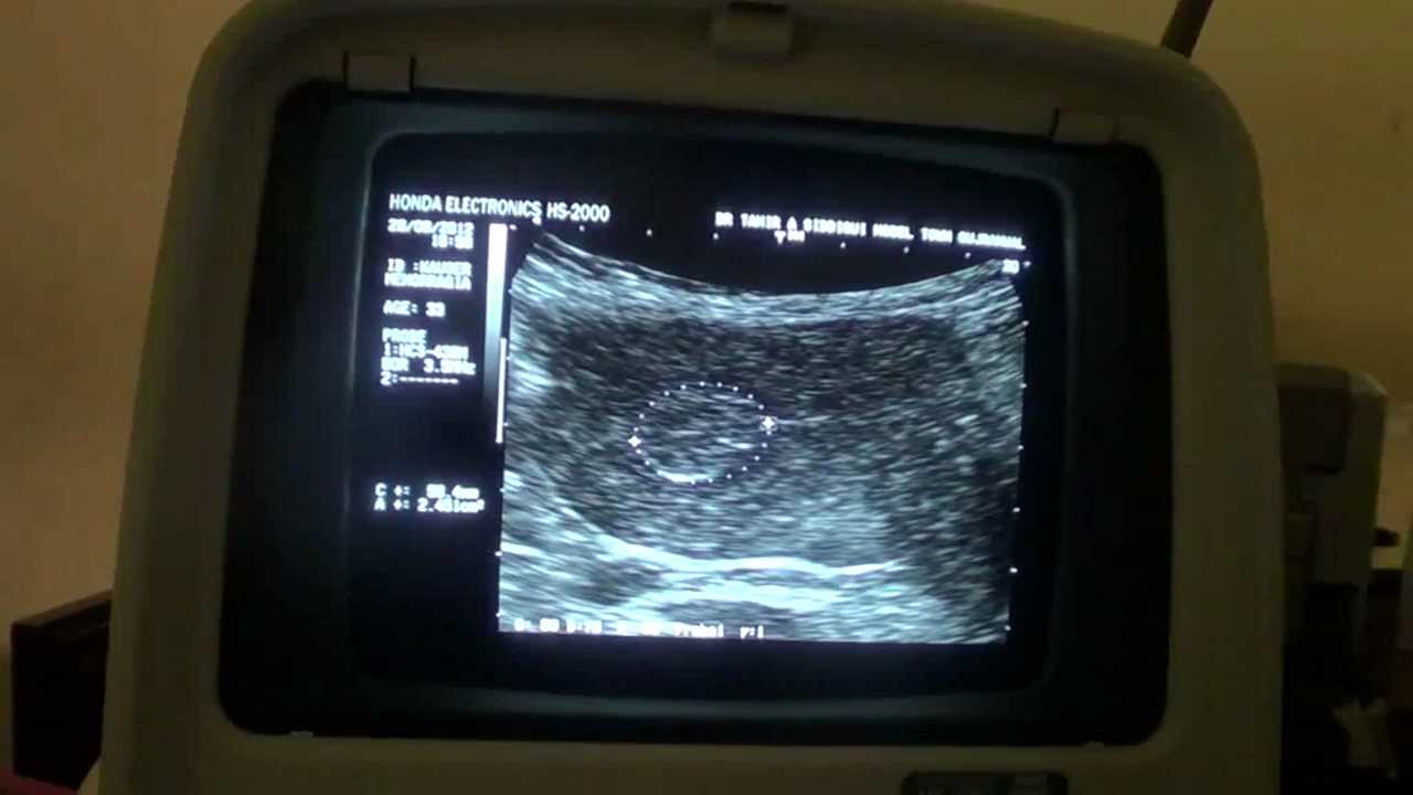 endometrial fundal region POLYP as a cause of MENORRAGIA - YouTube