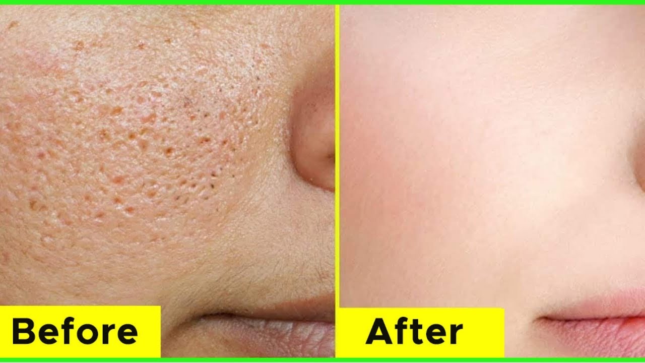 CLOSE OPEN PORES WITH APPLE CIDER VINEGAR IN ONE NIGHT - YouTube