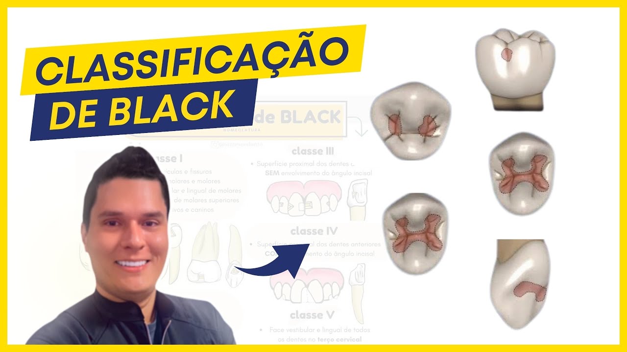 Classificações de Black | Dentística (Guia Completo). - YouTube