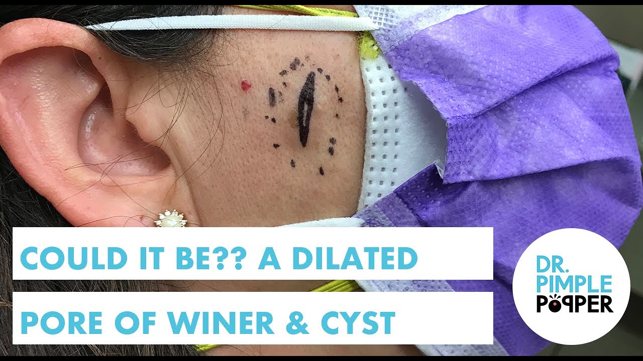 Could It Be?? A Dilated Pore of Winer & Cyst - YouTube