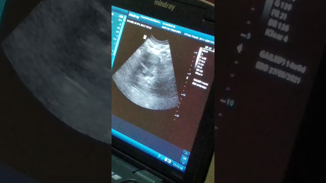 usg 2D 14 minggu, menit 3.10 jelas terlihat semuanya - YouTube