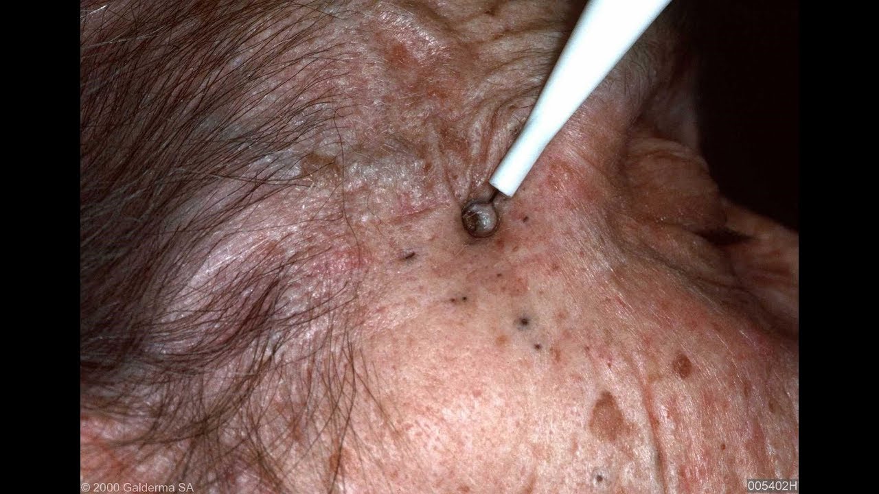 Comedone Extractor Tools Vs Blackhead Peel Mask 👍😃👍 - YouTube