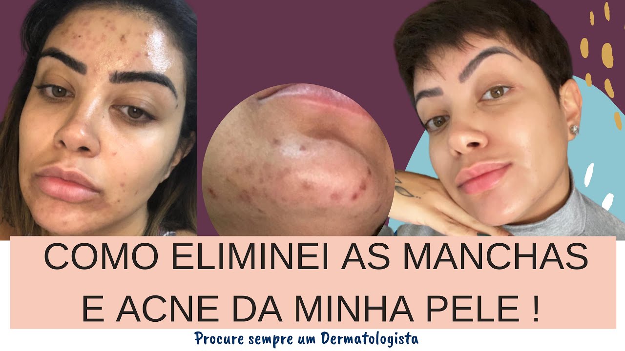 COMO ELIMINEI AS MANCHAS E ACNE DA MINHA PELE ! - YouTube