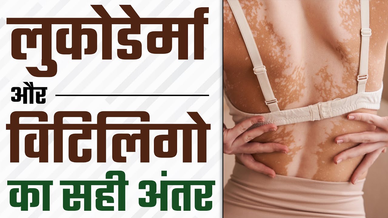 जानिये लुकोडेर्मा और विटिलिगो का सही अंतर | Difference Between ...