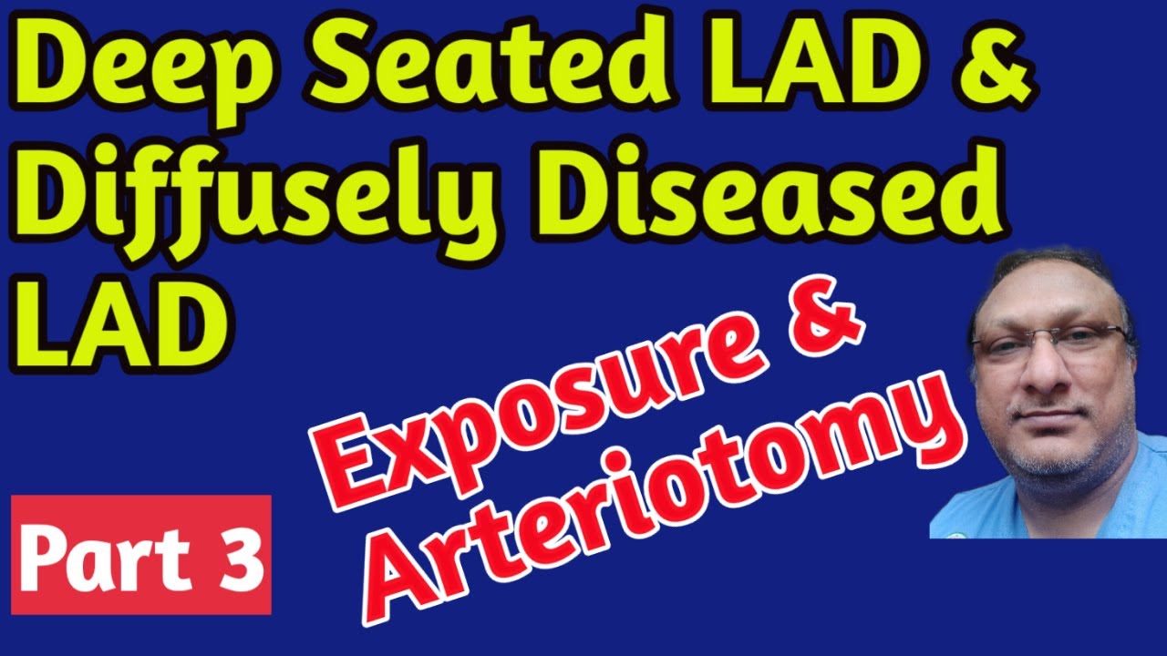 Coronary Arteriotomy in Deep Seated LAD & Diffusely Diseased LAD. How ...