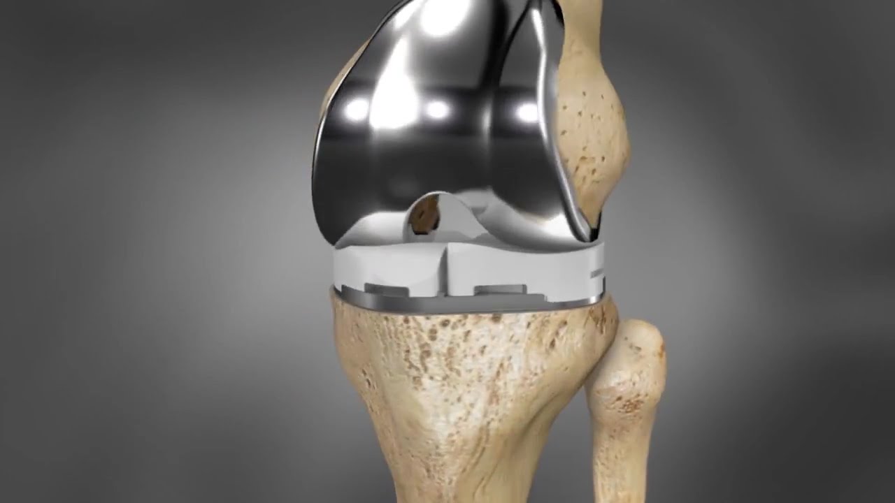 Second Sunday Bryan Health Report: Knee Replacement Surgery - YouTube