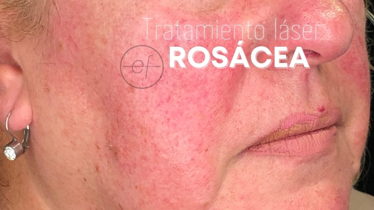 Tratamiento De La RosÁcea Con LÁser Youtube