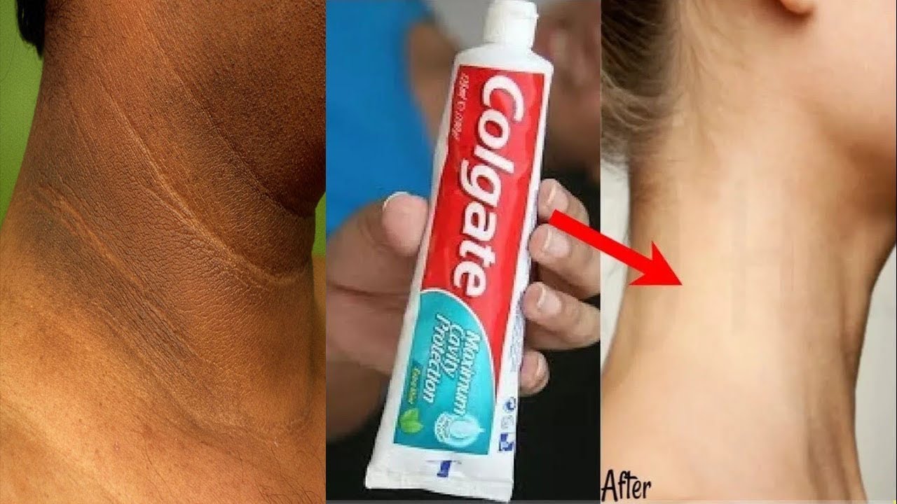 How To Get Rid Of Dark Neck Fast Naturally Turn Your Dark Black Body how-to-get-rid-of-dark-neck-fast-naturally-turn-your-dark-black-body