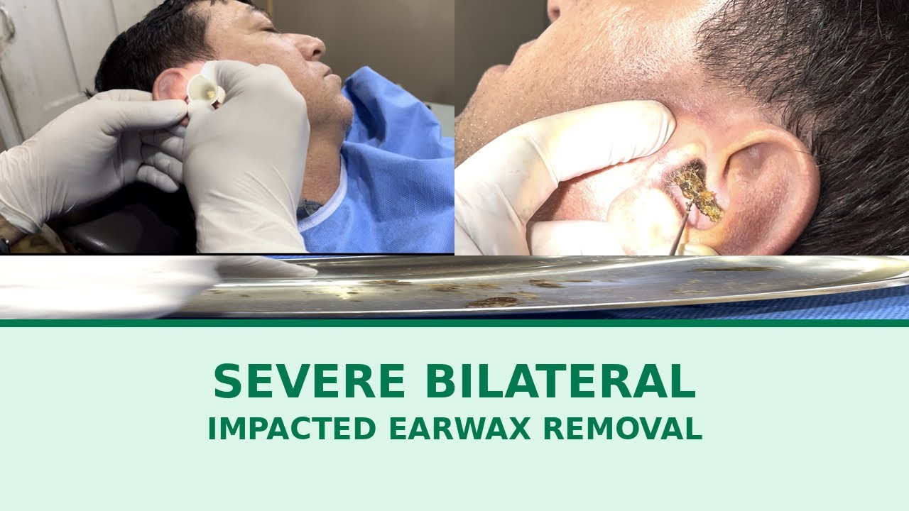 Severe Bilateral Impacted Ear Wax Removal/Safe Instrumentation ...