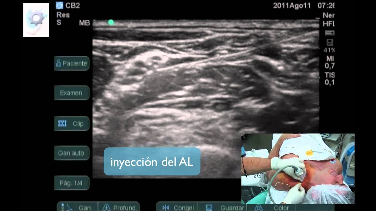 US Guided Interscalene brachial plexus block.mov - YouTube