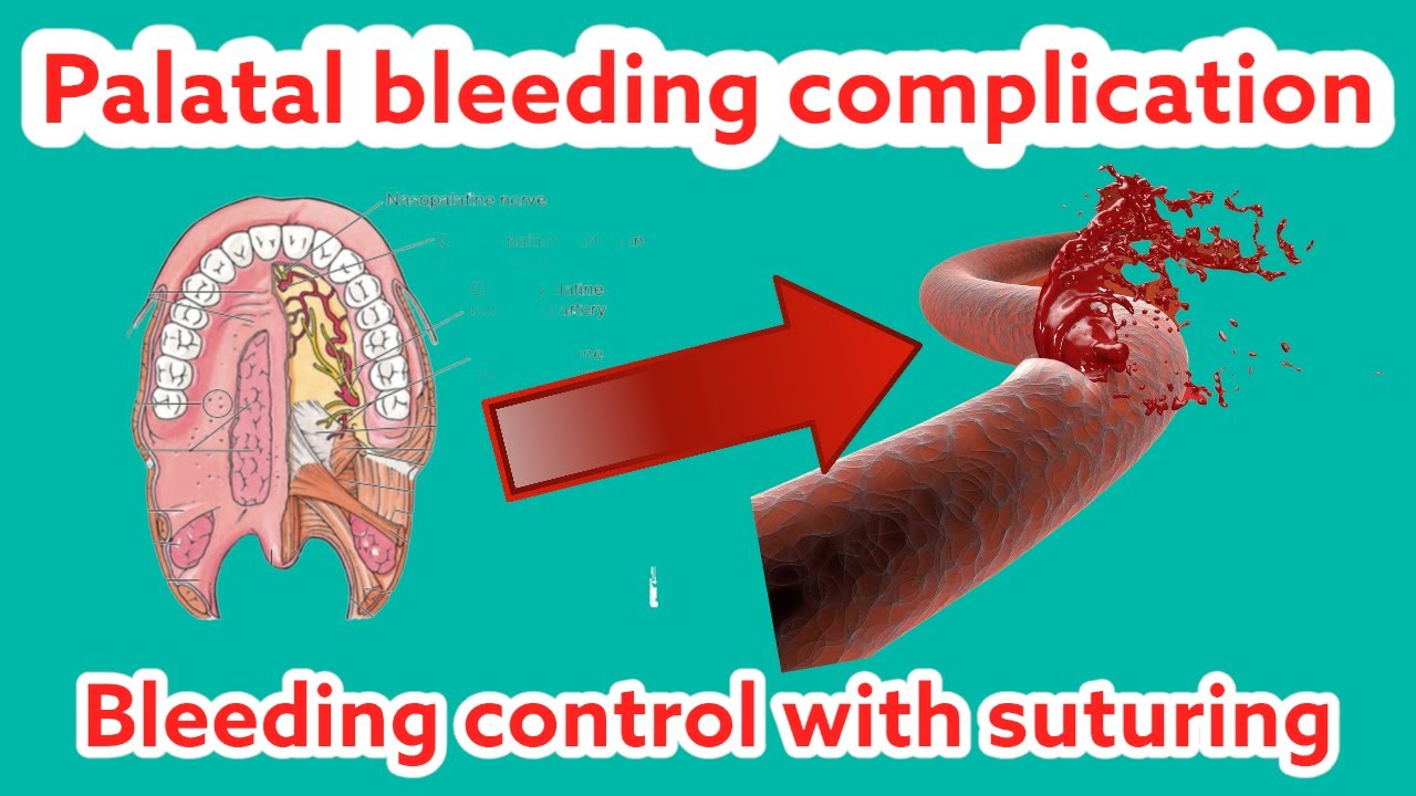 Bleeding control of the palatal blood vessel after ctg - YouTube