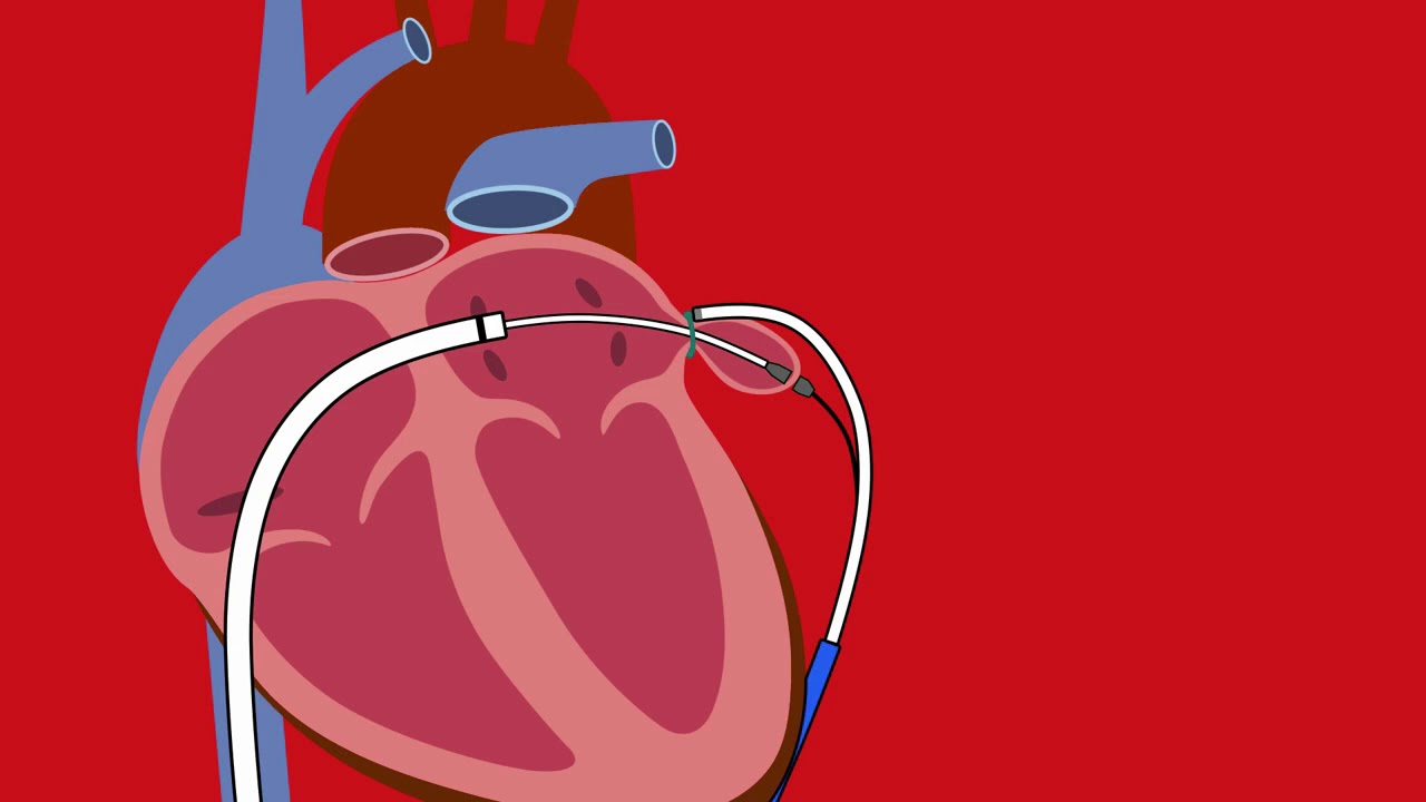 LARIAT® Suture Delivery Device for AFib - Willis Knighton Health - YouTube