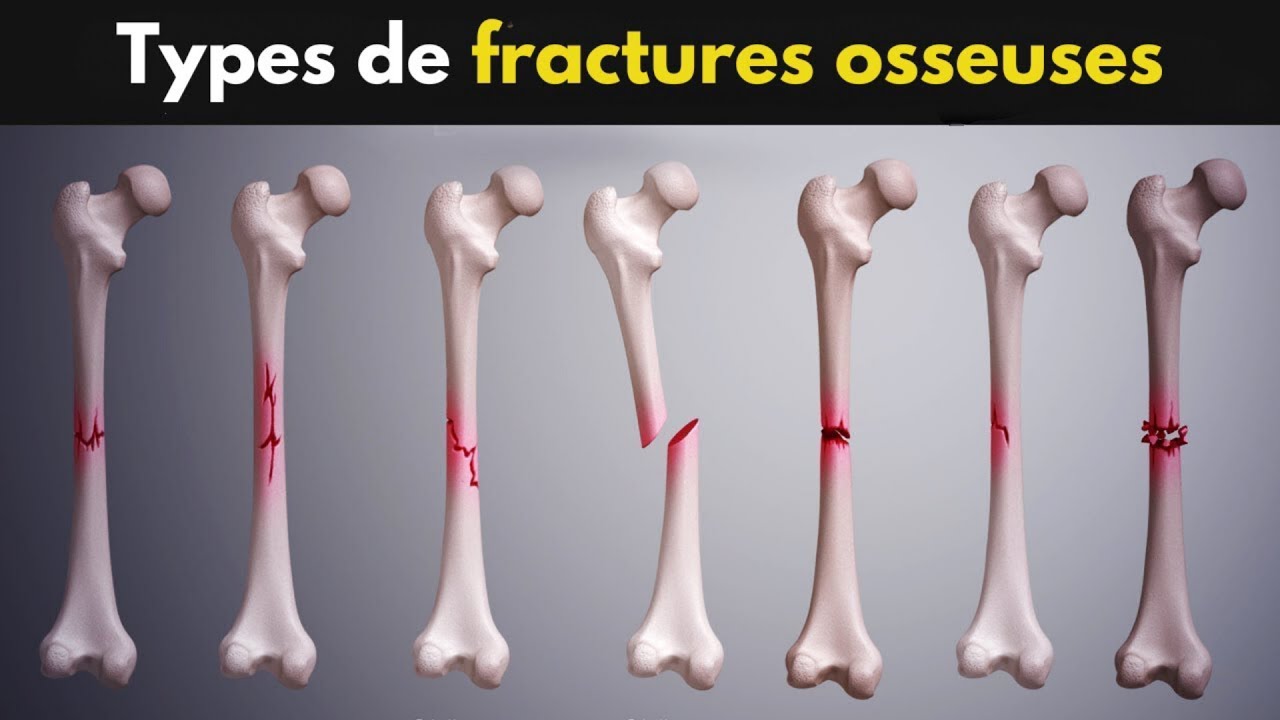 Comprendre les différents types de fractures - YouTube