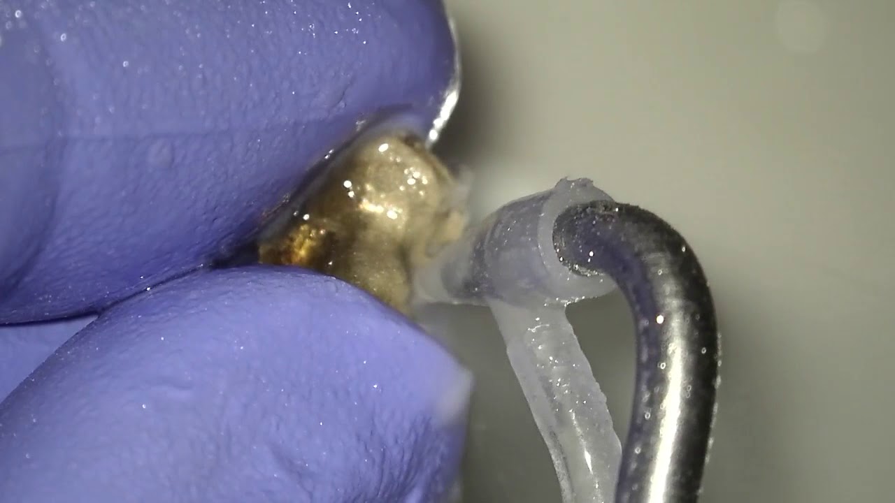 Cleaning inner surface just before re-cementation by Engin Taviloglu ...