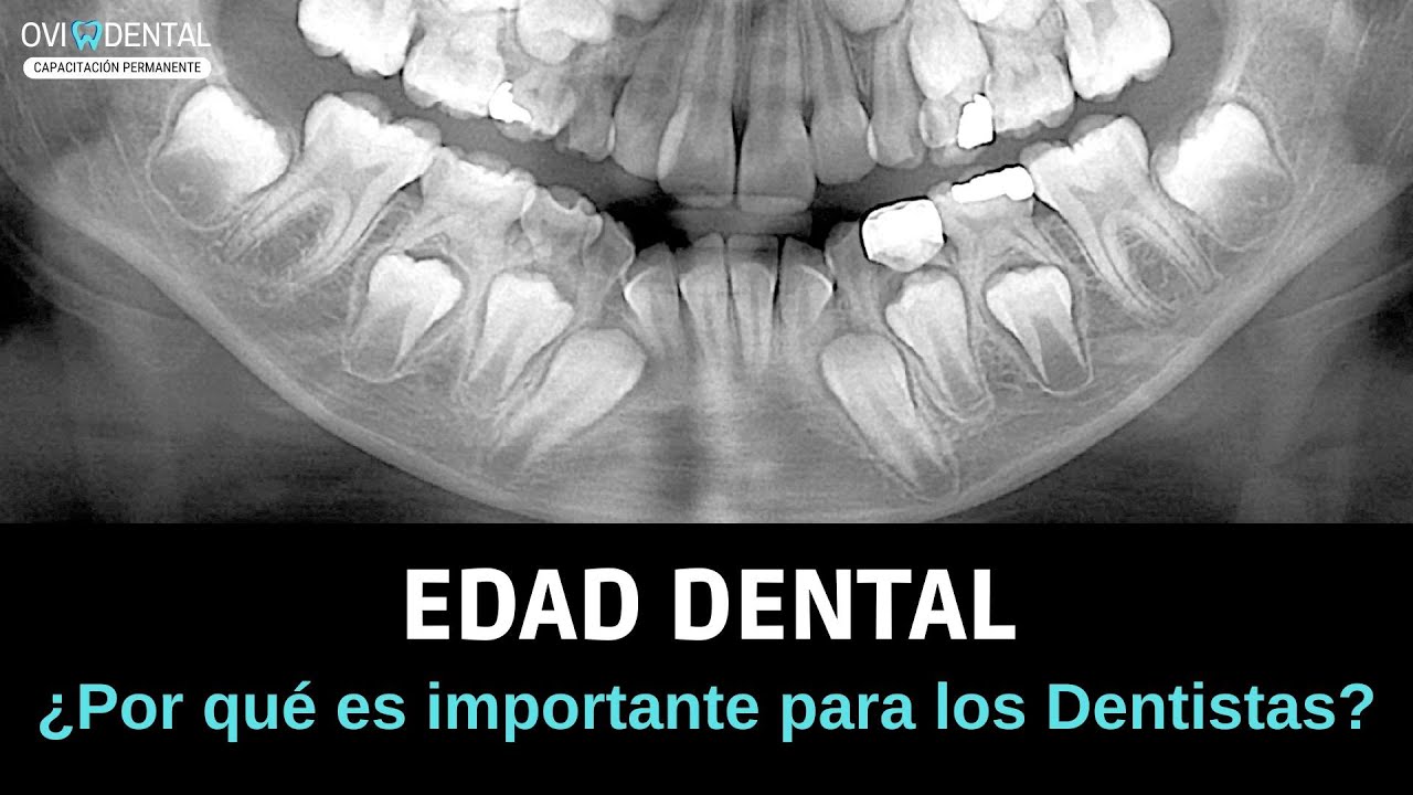 EDAD DENTAL ¿Por qué es importante para los Dentistas? - YouTube