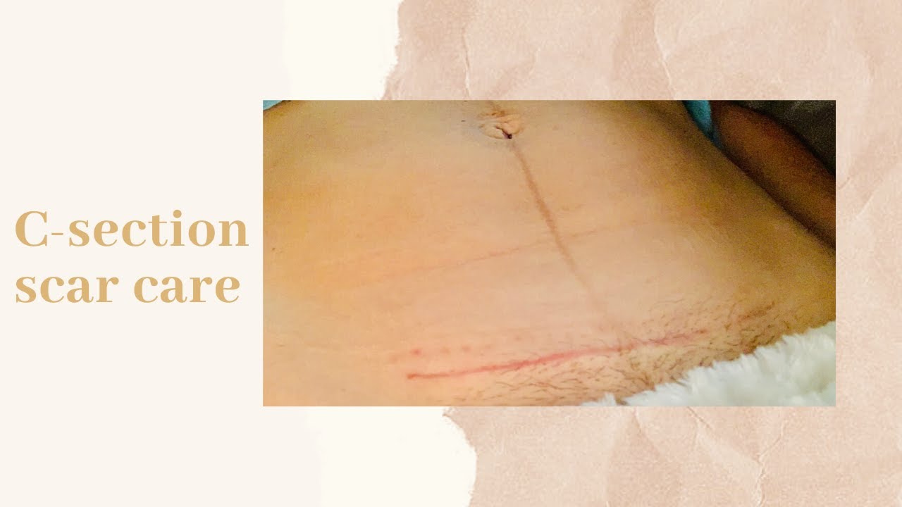 Cesarean Section Scar Care - YouTube