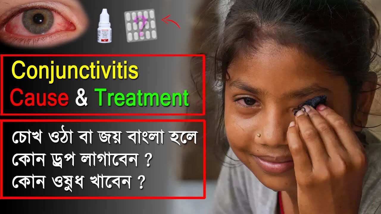 Say Goodbye to Conjunctivitis: Cause, Prevention & Treatment in Bengali ...