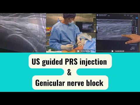 Ultrasound guided PRS injections + genicular nerve block - YouTube