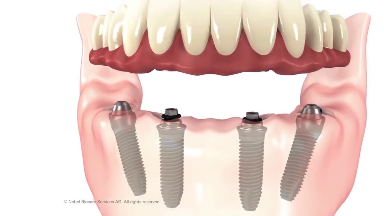 Animation Of How All On 4 Dental Implants Work - YouTube