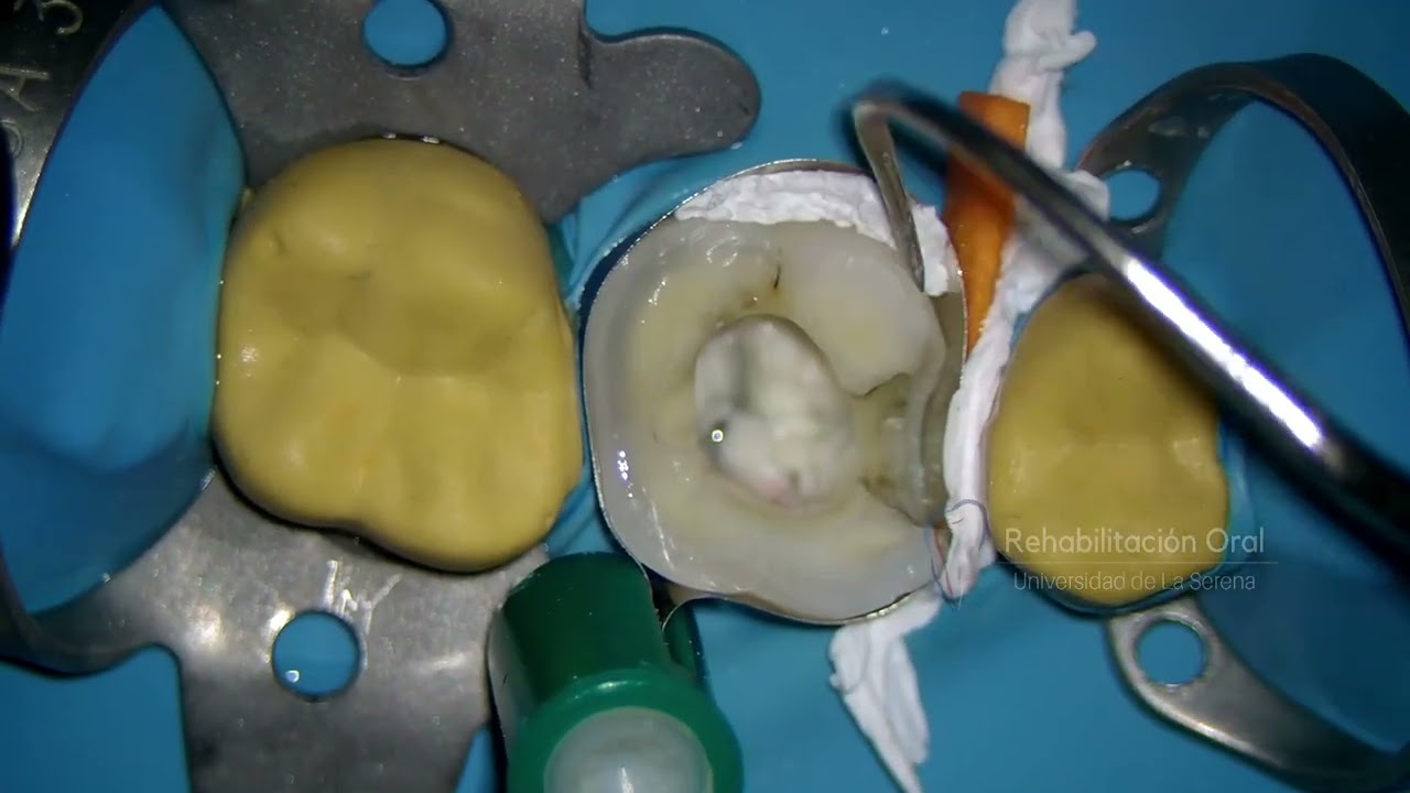 Preparación para Overlay en Diente con tratamiento endodóntico - YouTube