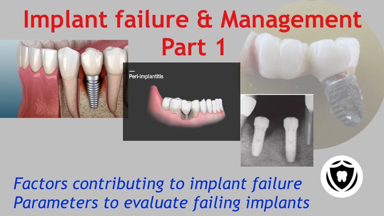 Implant failure & Management : Part 1 - YouTube