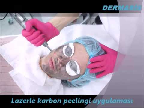 Lazerle karbon peelingi uygulaması sadece 75 TL ! Tel:0552 313 13 29  Dermaris Marmaris